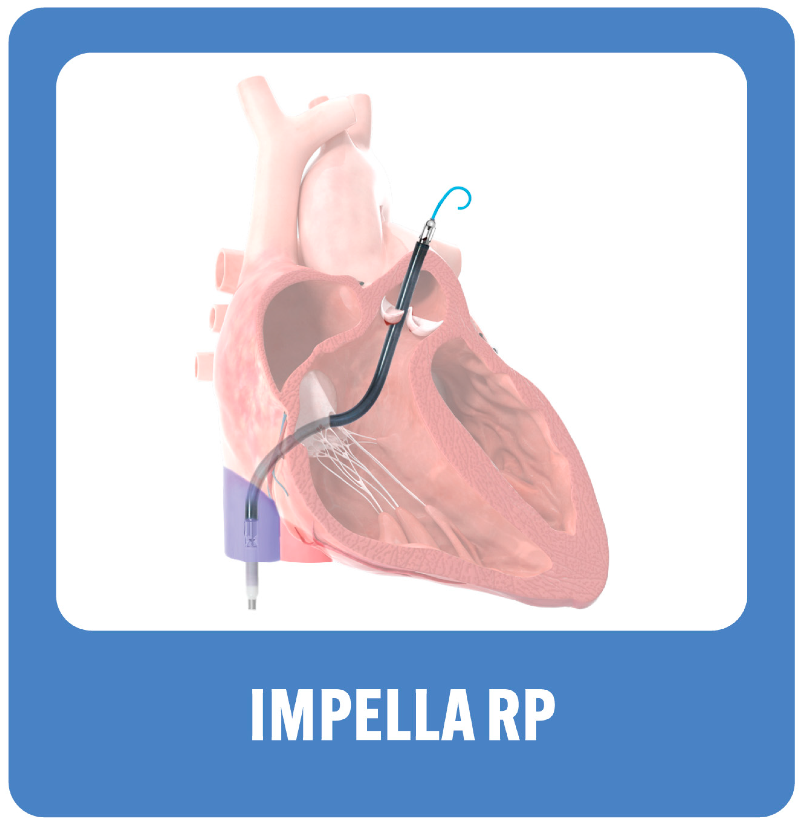 Mechanical Support in High-Risk Pulmonary Embolism: Review Article
