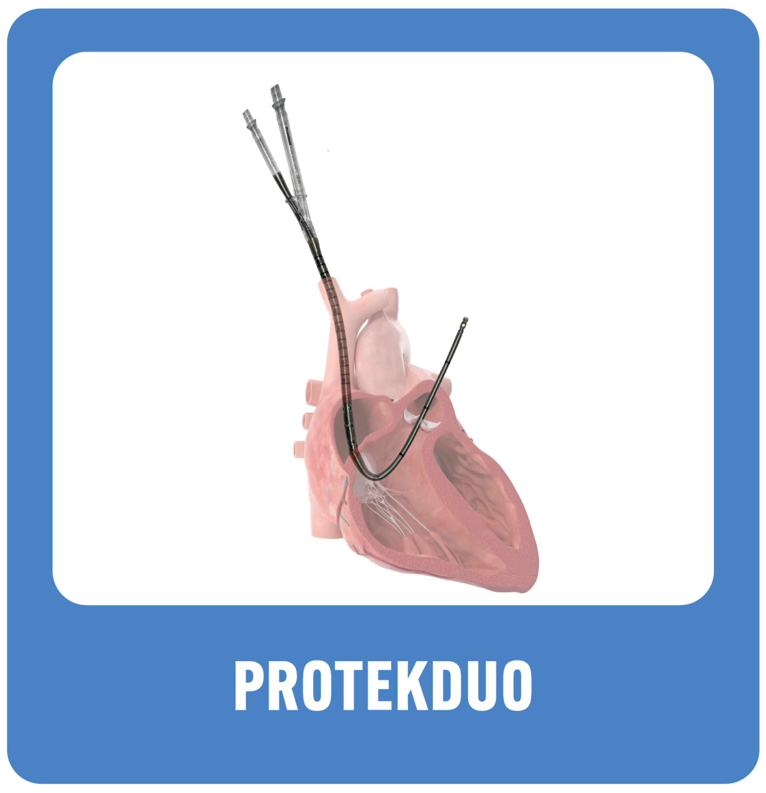 Mechanical Support in High-Risk Pulmonary Embolism: Review Article