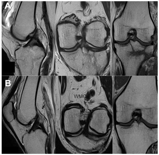 Nanosurgical and Bioengineering Treatment of Human Anterior Cruciate ...
