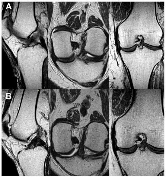 Nanosurgical and Bioengineering Treatment of Human Anterior Cruciate ...