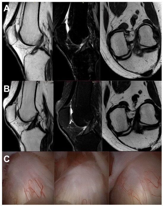 Nanosurgical and Bioengineering Treatment of Human Anterior Cruciate ...