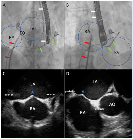 Transesophageal Echocardiography Improves Precision in Transseptal ...