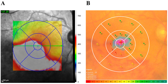 Visual Acuity and Retinal Thickness and Sensitivity after Intravitreal ...