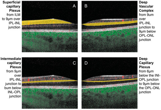 An OCT-A Analysis of the Importance of Intermediate Capillary Plexus in ...