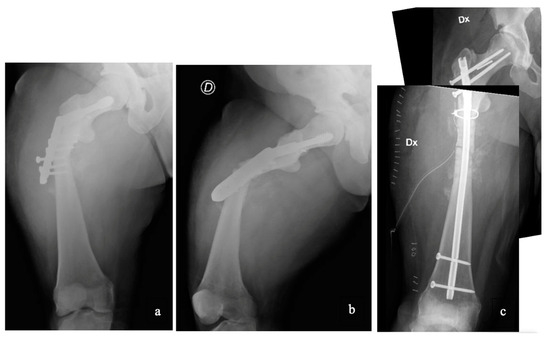 Pathological Fractures in Patients Affected by Pycnodysostosis: A Case ...