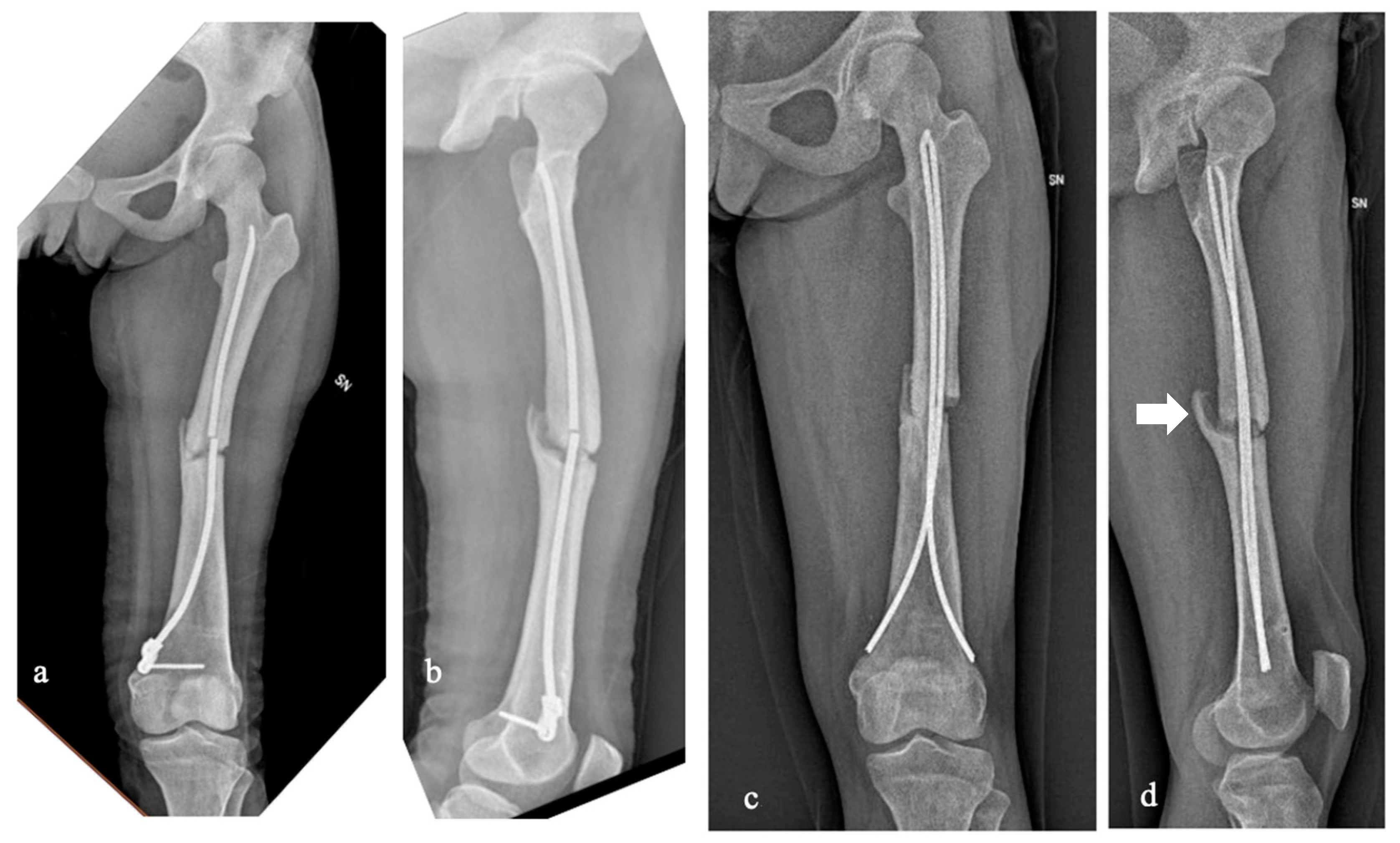 Pathological Fractures in Patients Affected by Pycnodysostosis: A Case ...