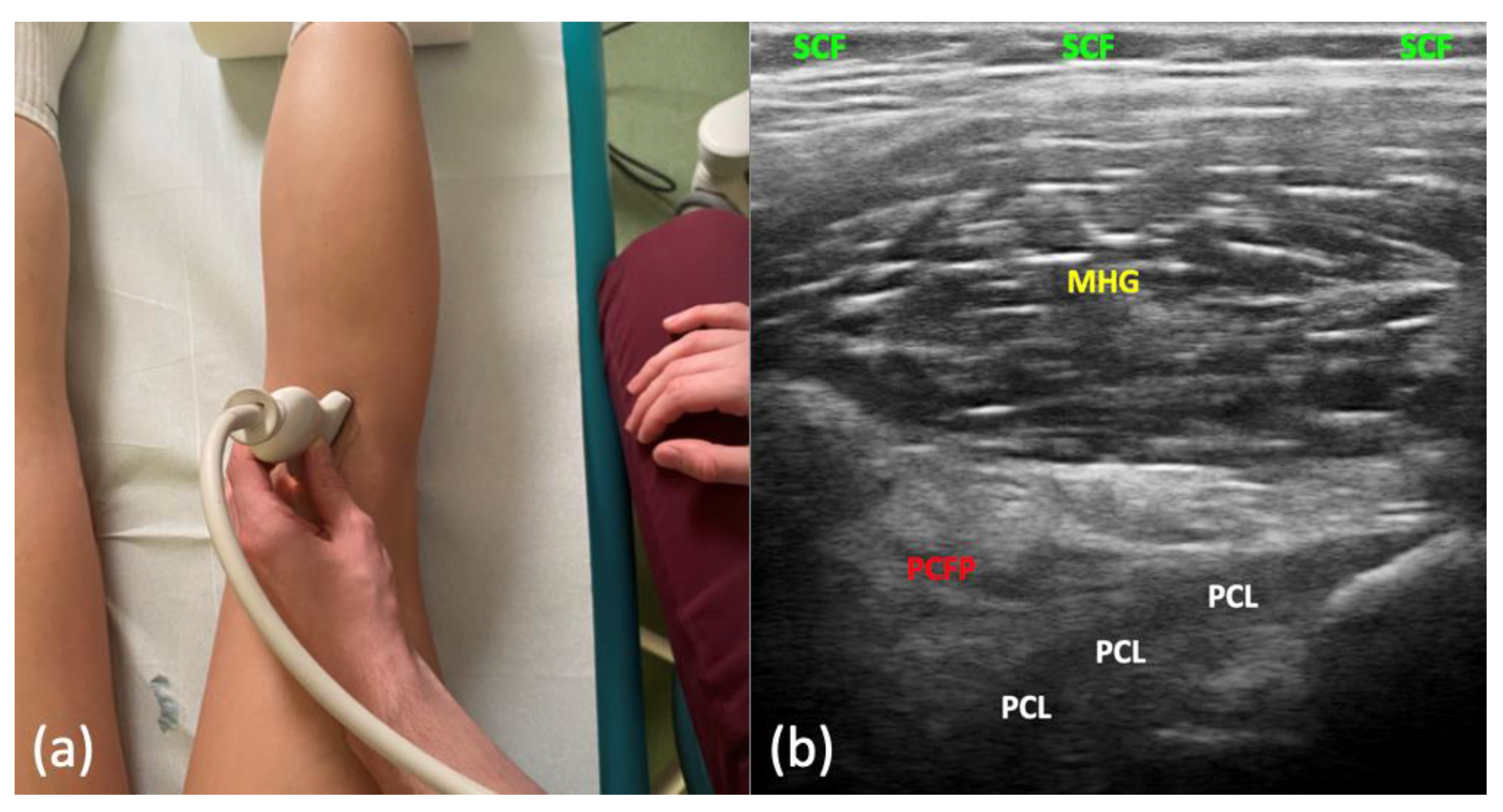 Sonographic Characterization of the Pericruciate Fat Pad with the Use ...