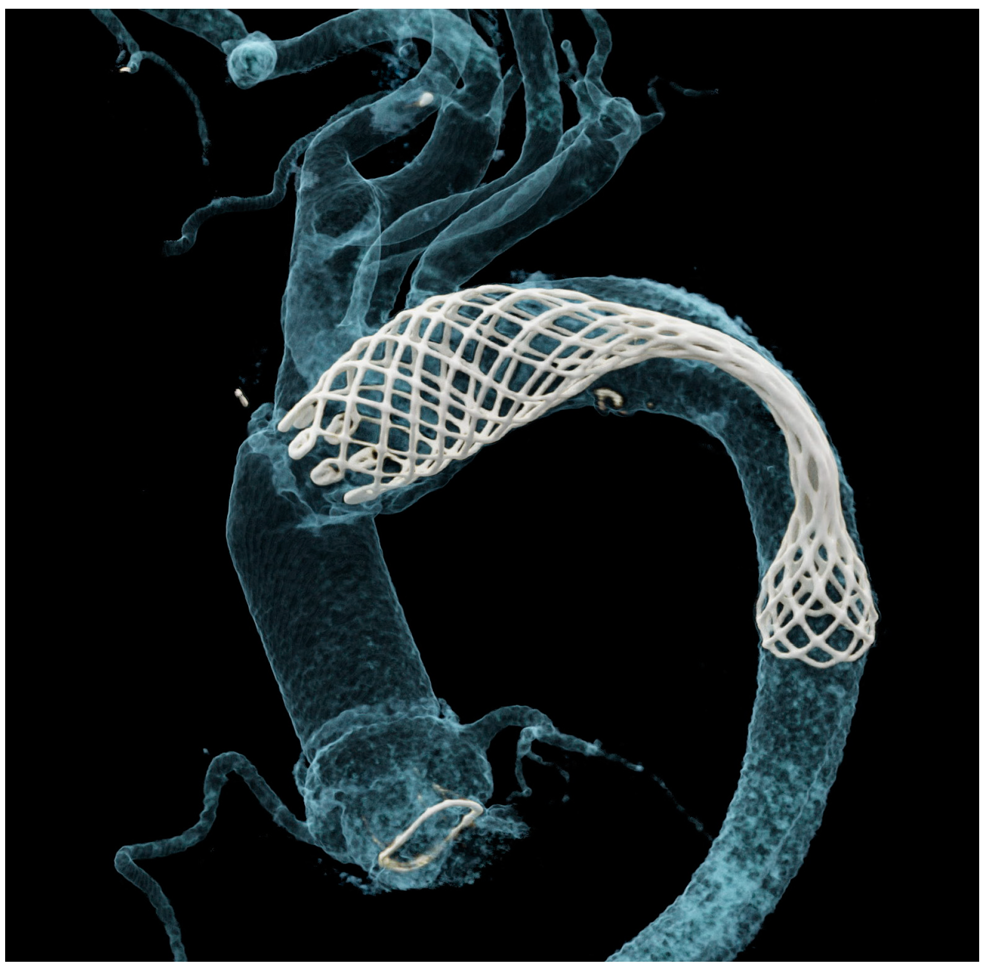 The Ascyrus Medical Dissection Stent: A One-Fits-All Strategy for the ...