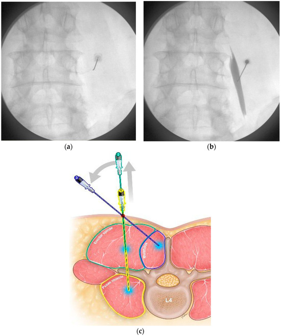 JCM | Free Full-Text | Effects of Paraspinal Intramuscular Injection of ...