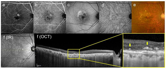 Drusen in AMD from the Perspective of Cholesterol Metabolism and ...