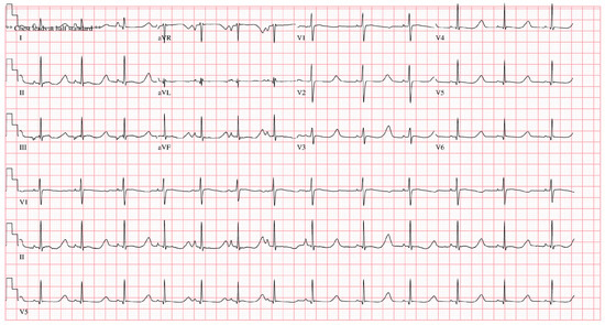 Reinforcement of a Subcutaneous Pocket for Implantable Cardioverter ...