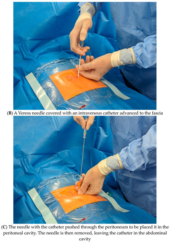 A New, Safe, and Effective Technique for Percutaneous Insertion of a Peritoneal Dialysis Catheter