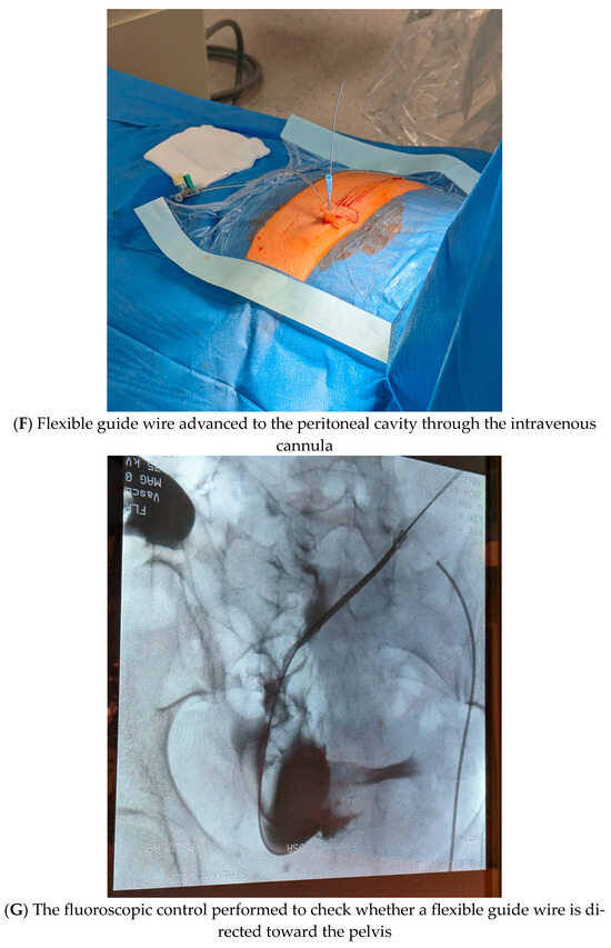 A New, Safe, and Effective Technique for Percutaneous Insertion of a Peritoneal Dialysis Catheter
