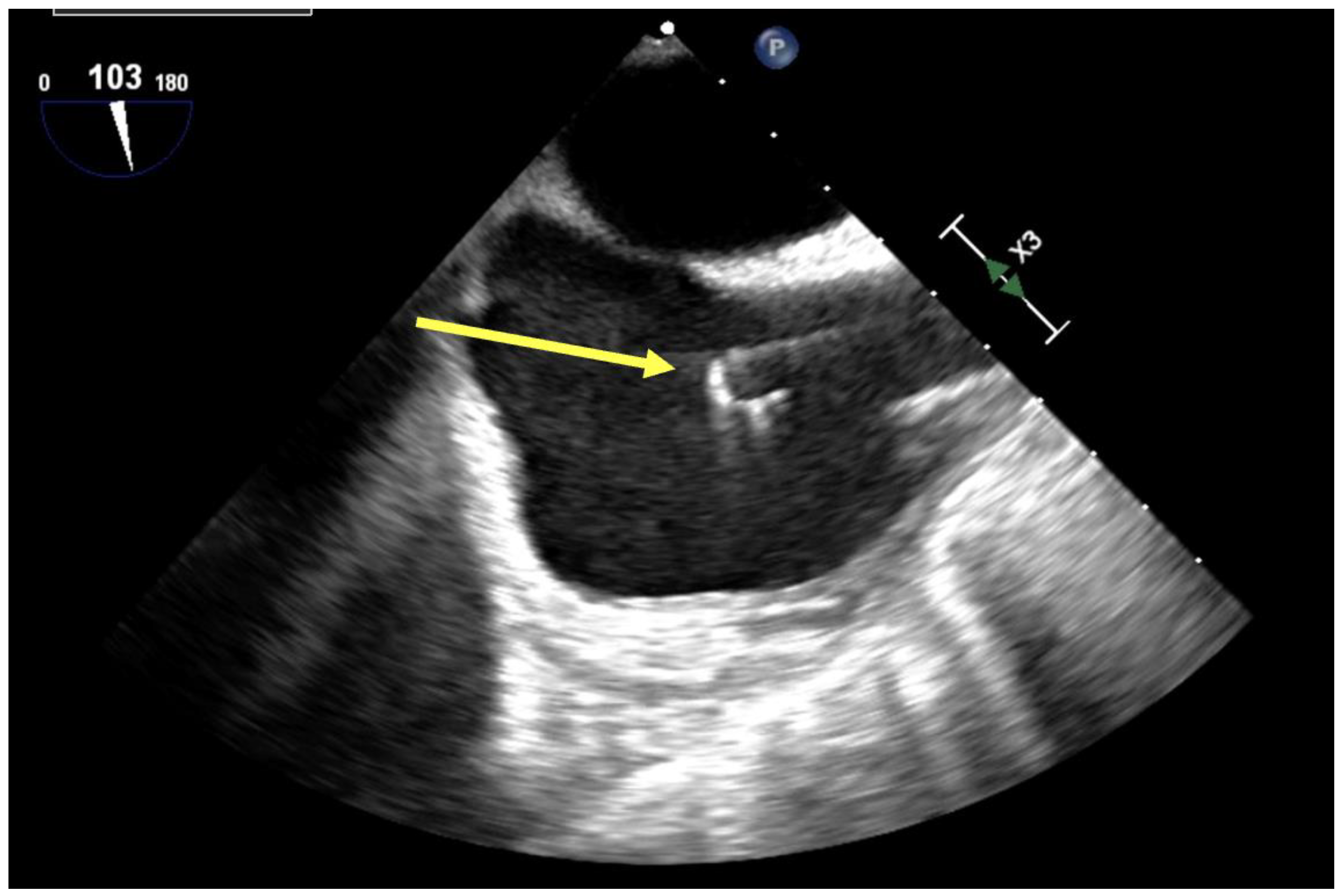 Echocardiographic and Point-of-Care Ultrasonography (POCUS) Guidance in ...