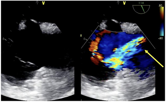 Echocardiographic and Point-of-Care Ultrasonography (POCUS) Guidance in ...