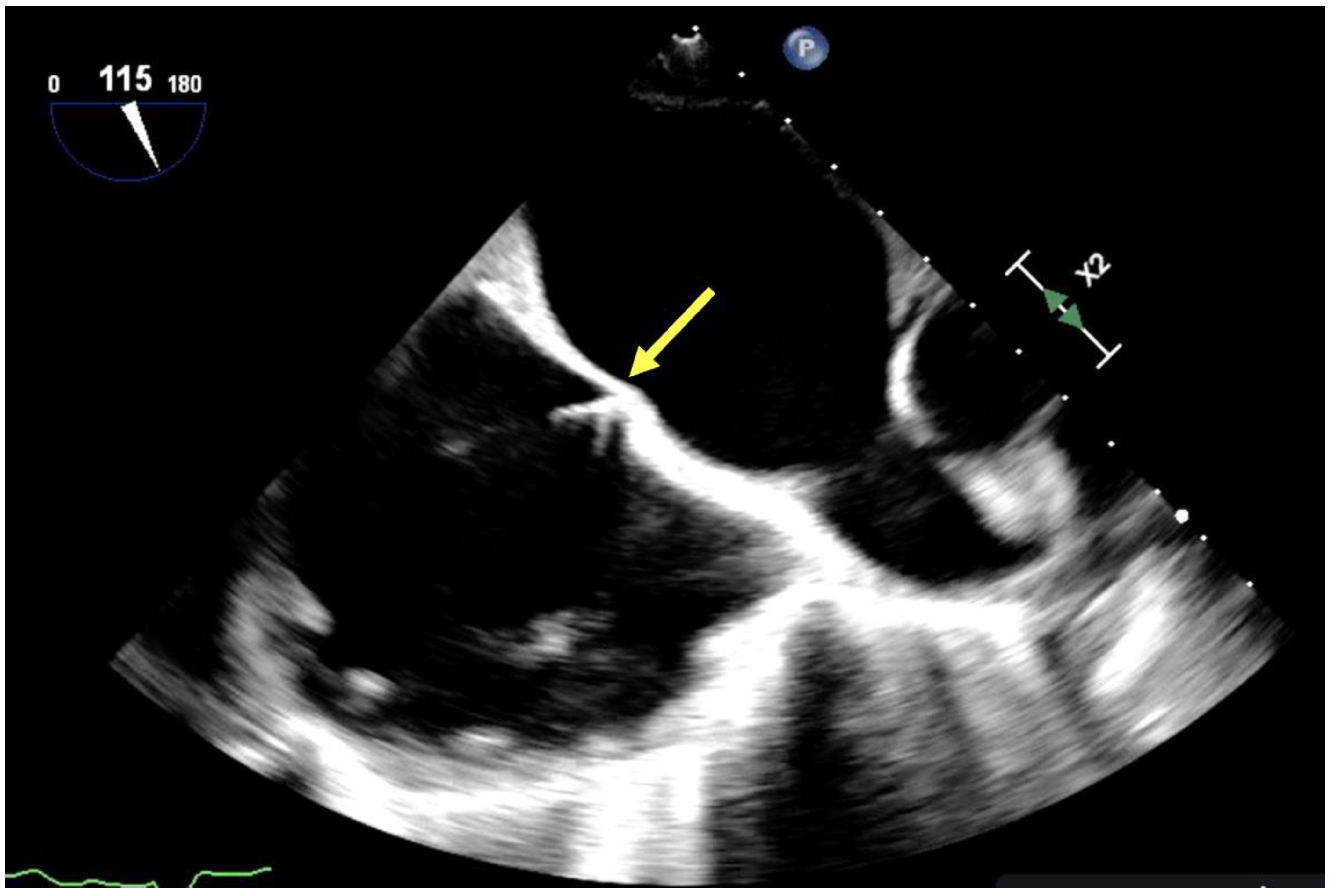 Echocardiographic and Point-of-Care Ultrasonography (POCUS) Guidance in ...