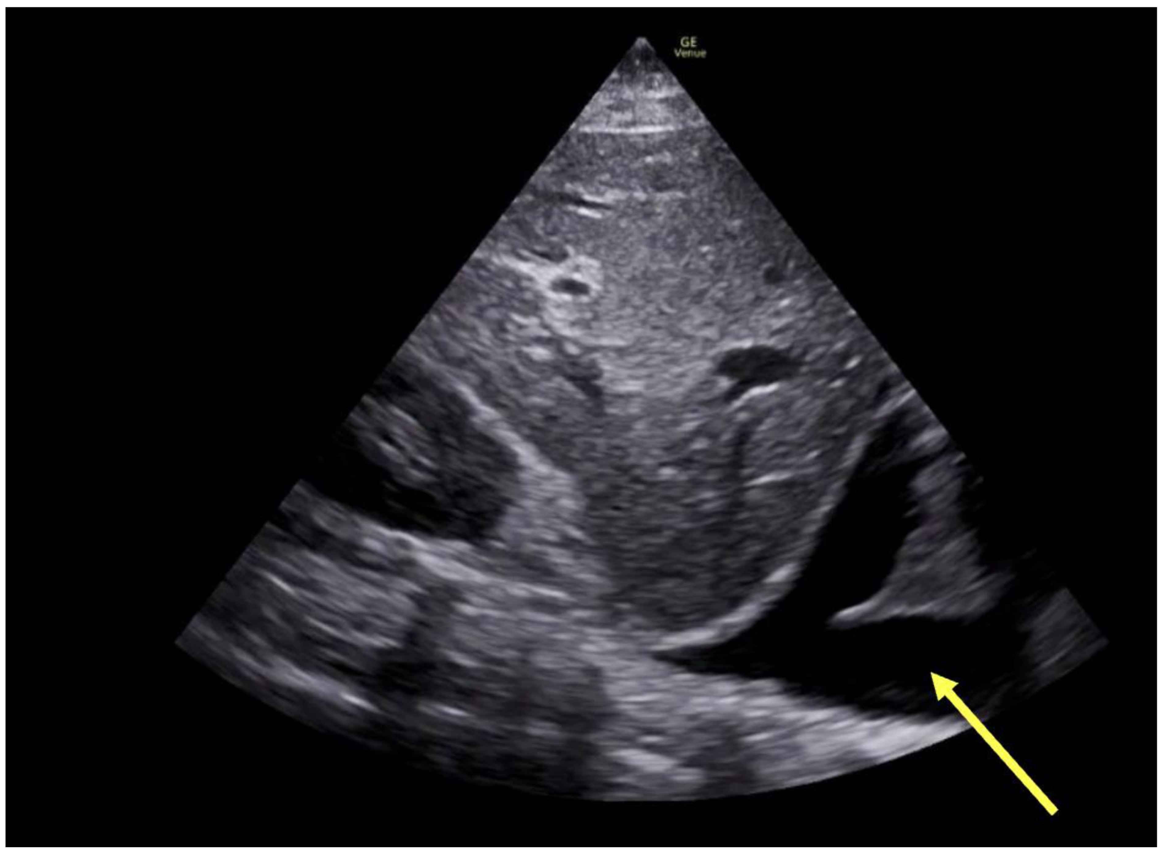 Echocardiographic and Point-of-Care Ultrasonography (POCUS) Guidance in ...