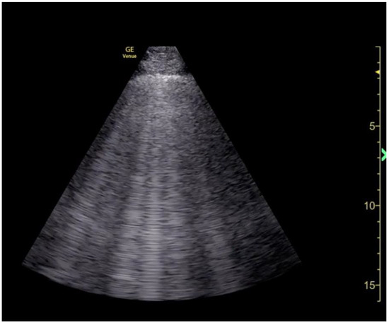 Echocardiographic and Point-of-Care Ultrasonography (POCUS) Guidance in ...