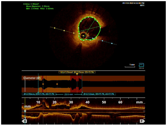 Kissing Balloon-Stent Technique for Simple Bifurcation Lesions