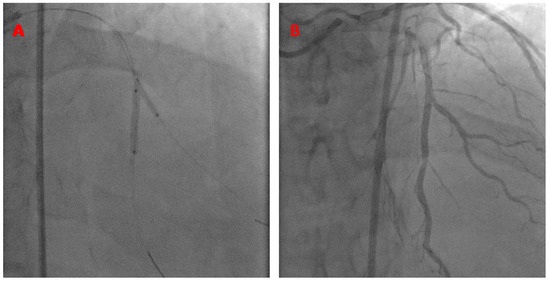 Kissing Balloon-Stent Technique for Simple Bifurcation Lesions
