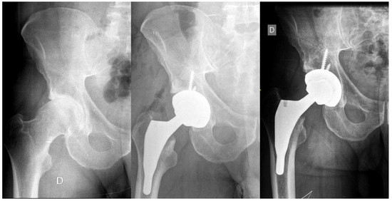 Total Hip Replacement with a Fully Hydroxyapatite-Coated Shortened Stem ...