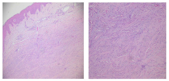 Nodular/Keloidal Scleroderma with No Systemic Involvement—A Case Report ...