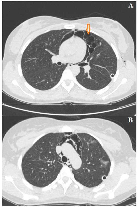 Re-Expansion Pulmonary Edema as a Life-Threatening Complication in ...