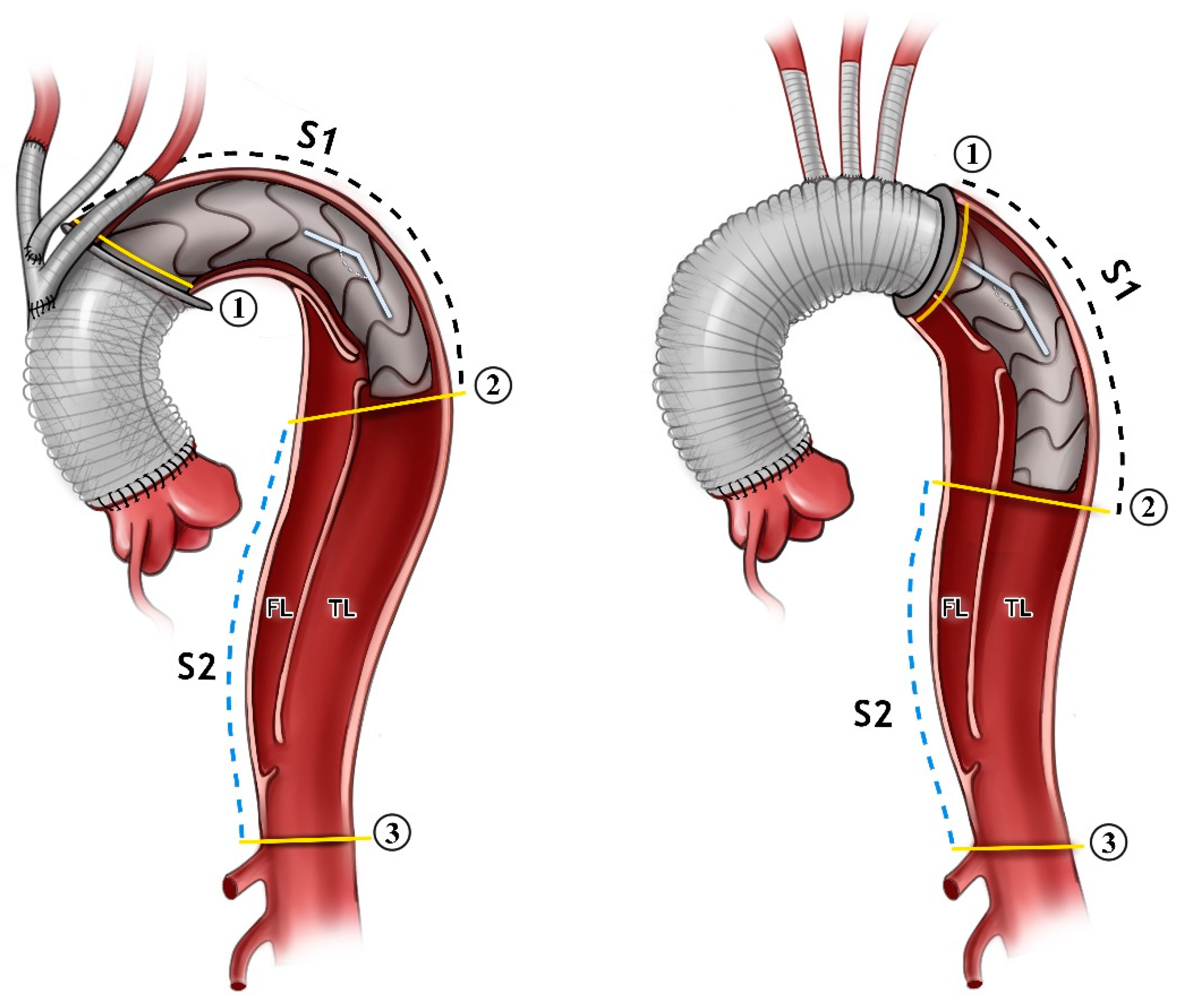 JCM | Free Full-Text | Three-Dimensional-Evaluation of Aortic Changes ...