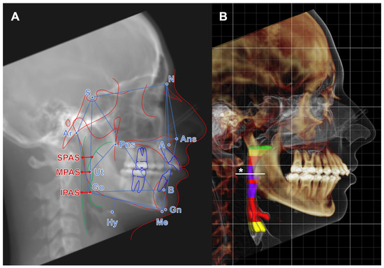 JCM | Free Full-Text | Cephalometric Screening Assessment for Superior Airway Space Narrowing ...