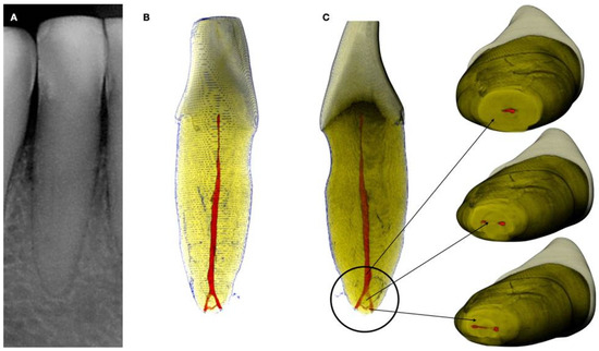 JCM | Free Full-Text | Negotiation of Calcified Canals