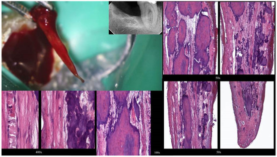 Negotiation of Calcified Canals
