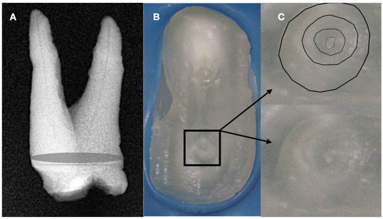 Negotiation of Calcified Canals