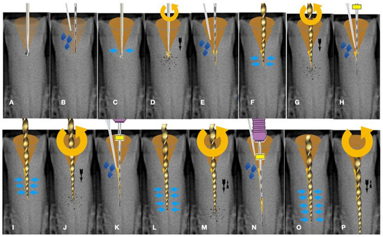 JCM | Free Full-Text | Negotiation of Calcified Canals