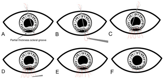 Iris Reconstruction: A Surgeon’s Guide