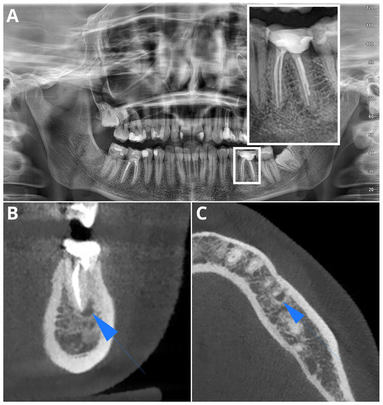 Periapical Lesions in Panoramic Radiography and CBCT Imaging—Assessment ...