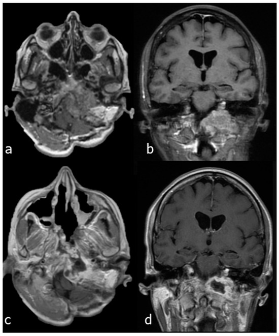 Combined Endoscopic Endonasal Transclival and Contralateral ...