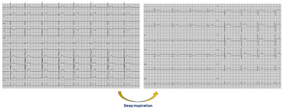 Physiological Changes in QRS Fragmentation in Athletes and Nonathletes ...