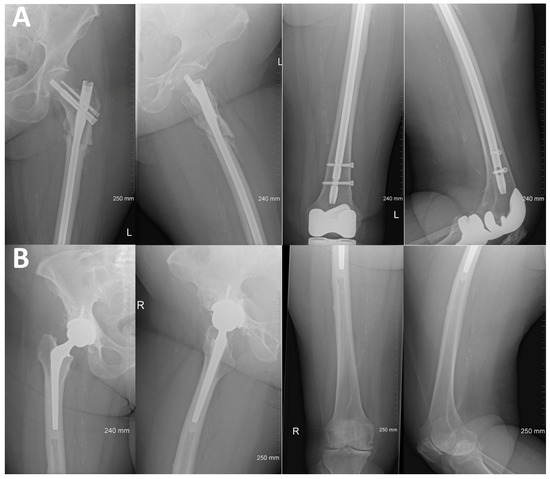JCM | Free Full-Text | Bilateral Atypical Femoral Fracture in a ...