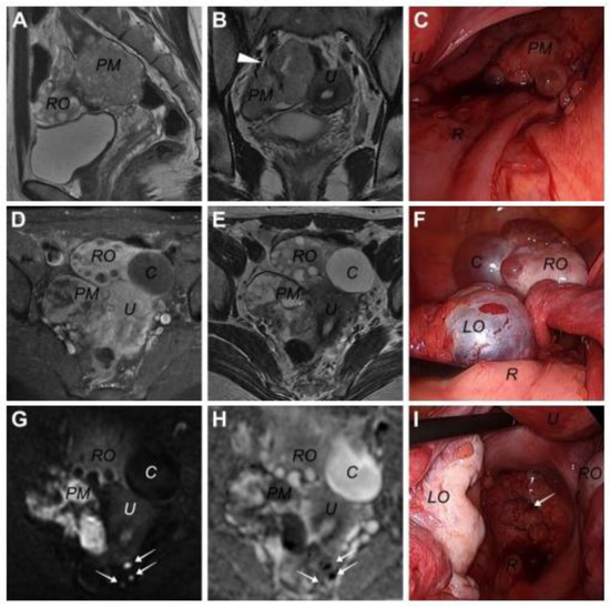 Primary Solid Pseudopapillary Tumor of the Ovary: A Case Report and Review of the Literature