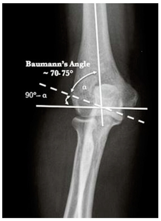 Lateral Humeral Condyle Fracture in Childhood: Results of a New ...