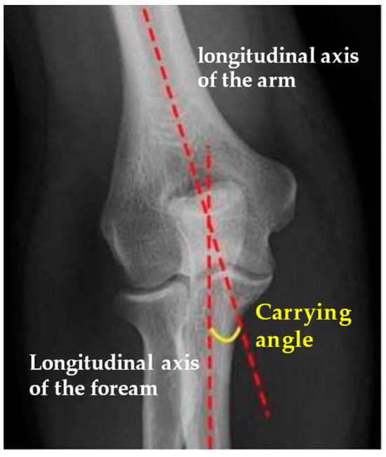 Lateral Humeral Condyle Fracture in Childhood: Results of a New ...
