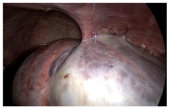 JCM | Free Full-Text | Peritoneal Dialysis-Induced Encapsulating ...