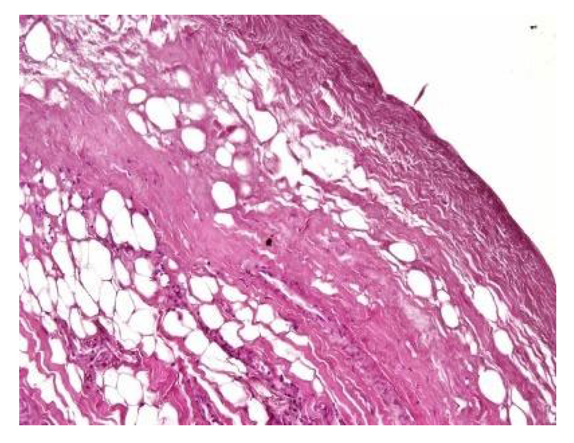 JCM | Free Full-Text | Peritoneal Dialysis-Induced Encapsulating ...