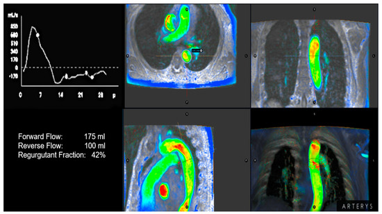 Aortic Regurgitation: From Valvular to Myocardial Dysfunction