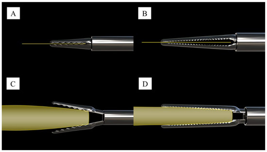 Direct Intraocular Lens Extraction Using a Newly Developed Lens ...