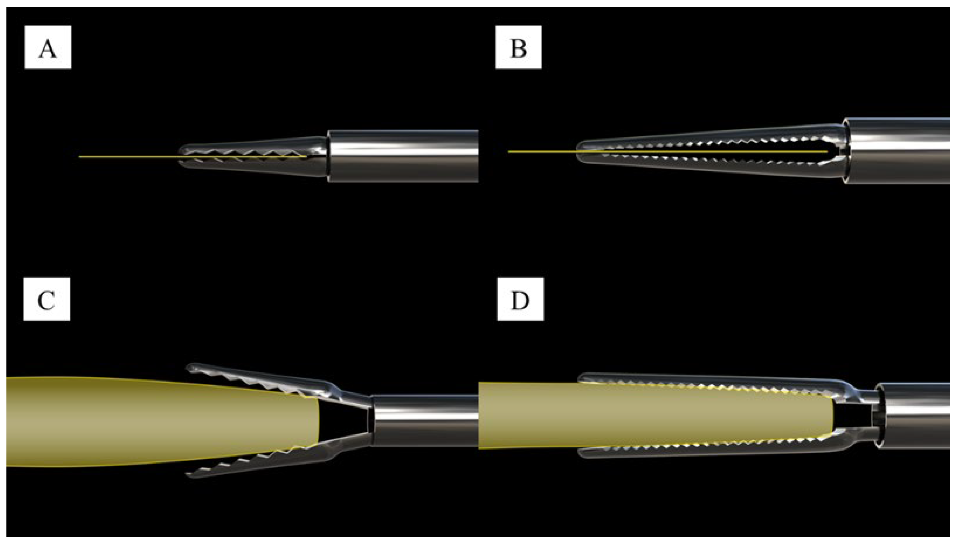 Direct Intraocular Lens Extraction Using a Newly Developed Lens ...