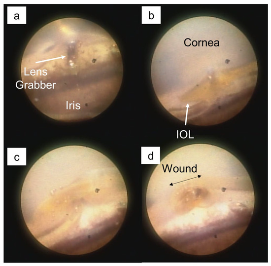 Direct Intraocular Lens Extraction Using a Newly Developed Lens ...