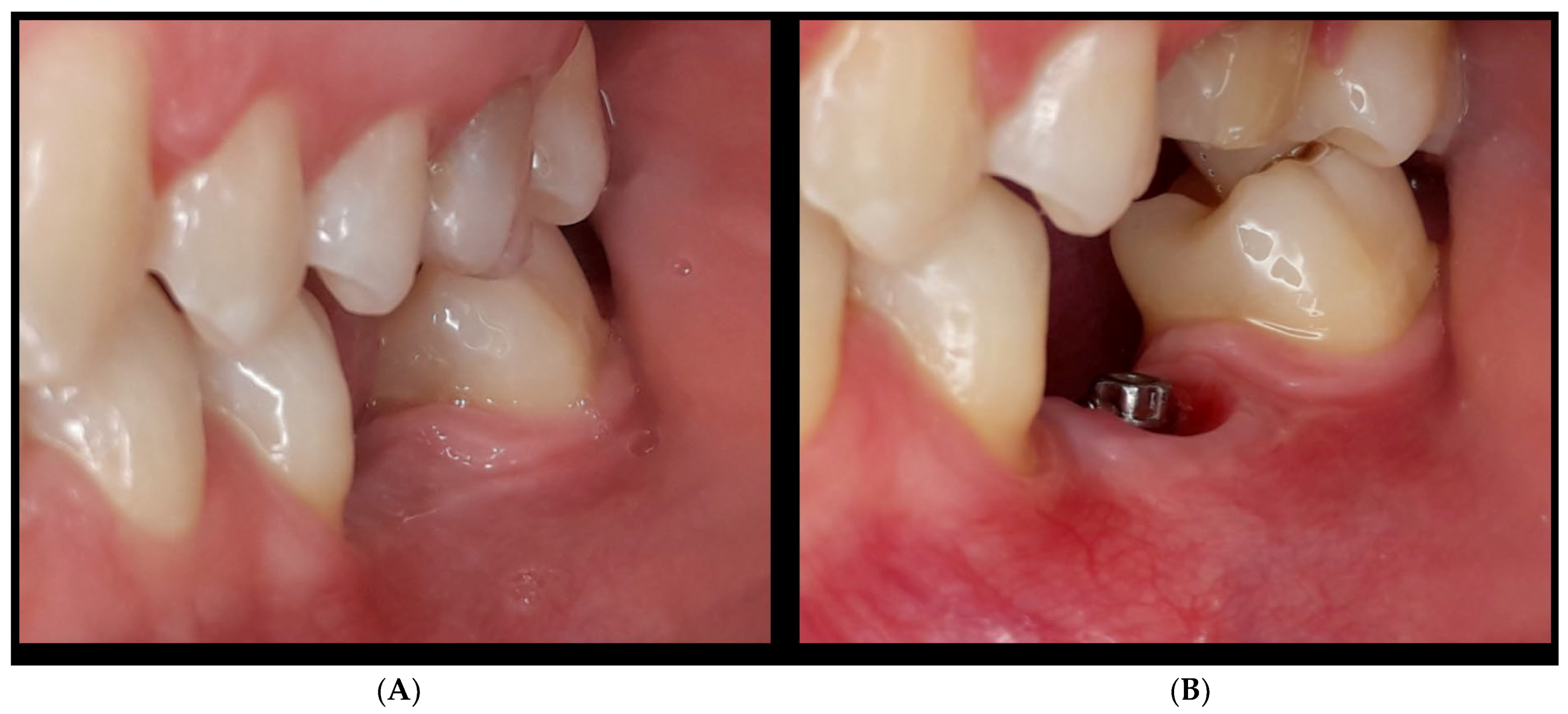 High-Density Dermal Matrix for Soft Tissue Augmentation Using a Matrix ...