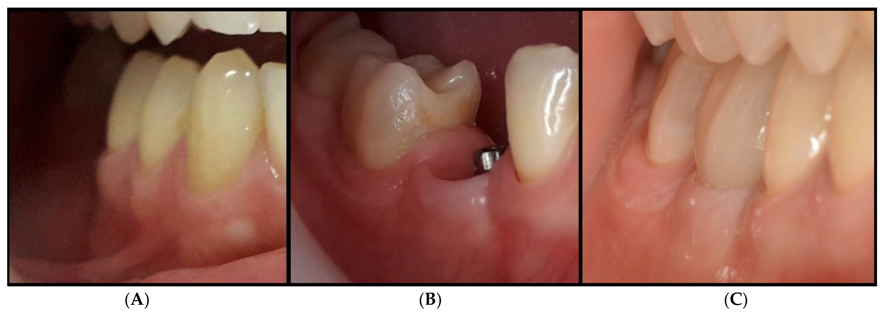 High-Density Dermal Matrix for Soft Tissue Augmentation Using a Matrix ...