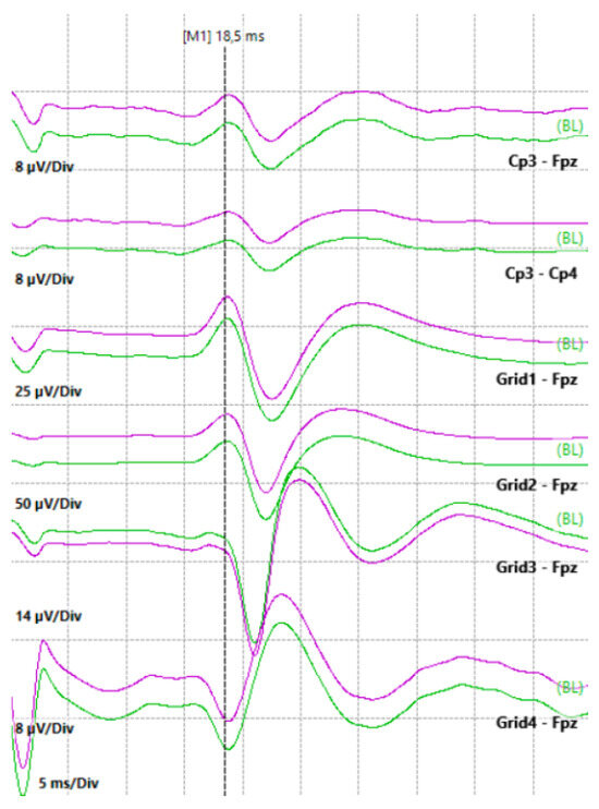 Intraoperative Neurophysiological Monitoring in Neurosurgery
